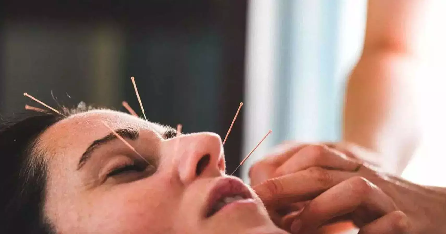 Acupuncture ihu ọ nwere ike bụrụ isi ihe na akpụkpọ ahụ nke ntorobịa? 12351_0